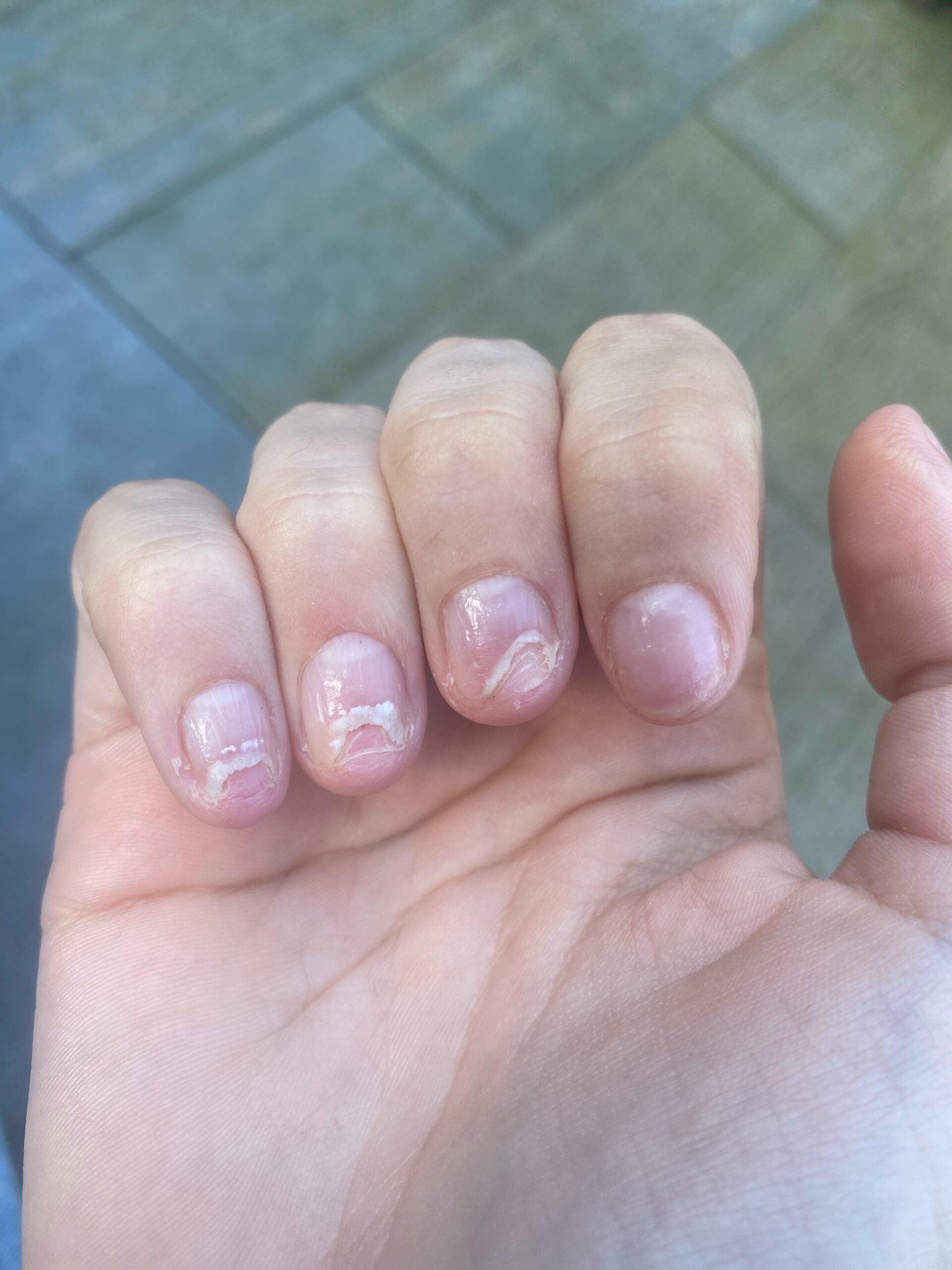 how to fix damaged nails from digging underneath them? – COSMESTIC.COM ...