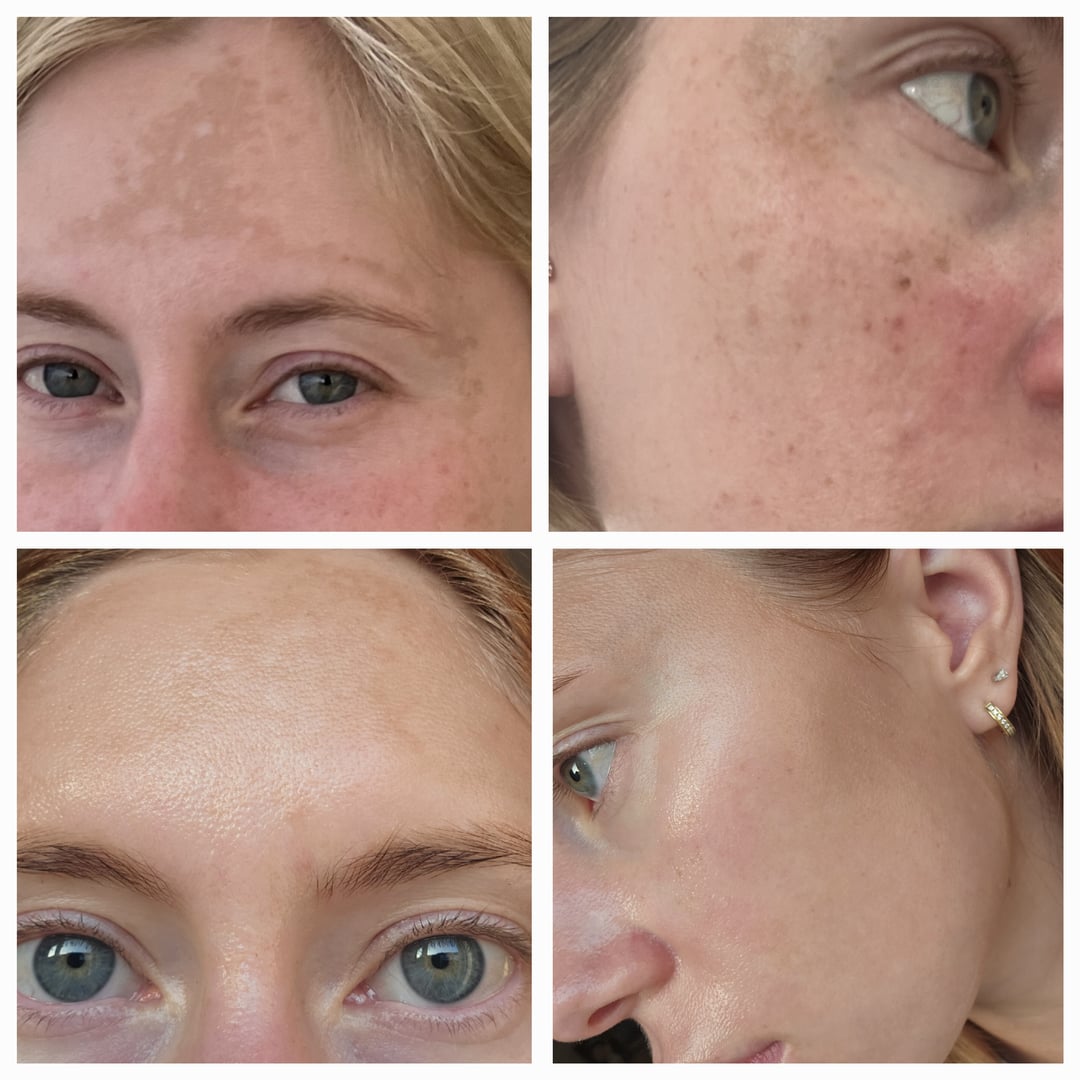 Melasma and hormonal acne progress! – COSMESTIC.COM ~ Beauty, Makup ...