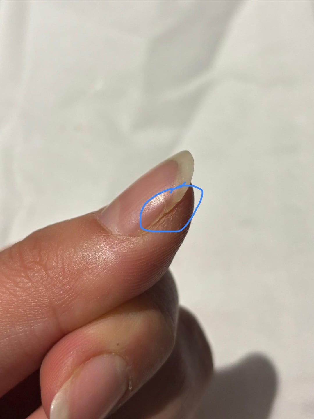Thumb nail always cracks when it reaches a certain length, any advice ...