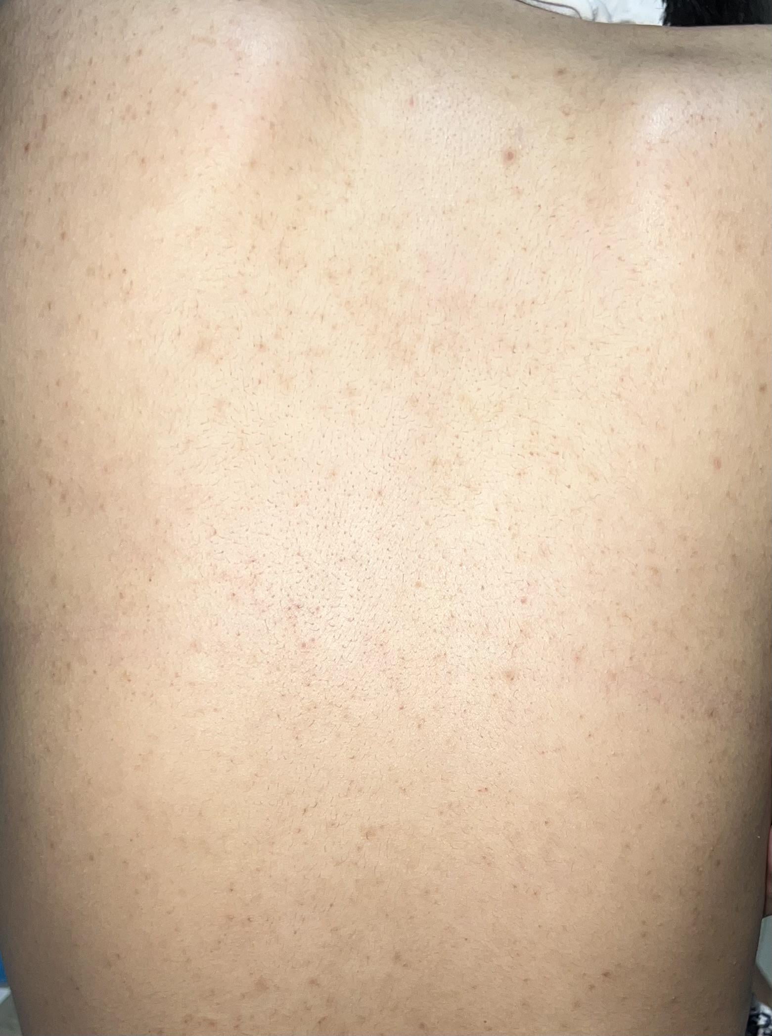 How to fade dark spots on back? – COSMESTIC.COM ~ Beauty, Makup, and ...