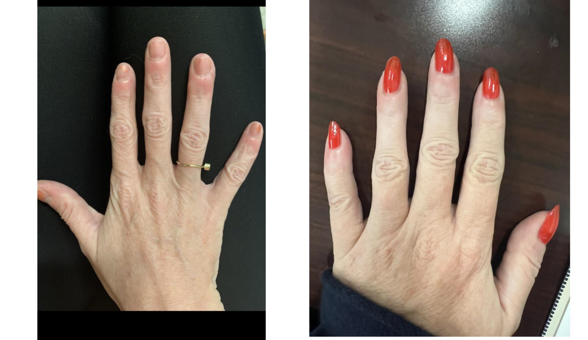 Nail progress after 20 years of biting - COSMESTIC.COM ~ Beauty, Makup ...